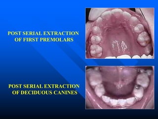 Interceptive Orthodontics | PPT