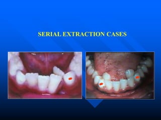 Interceptive Orthodontics | PPT