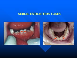 Interceptive Orthodontics | PPT