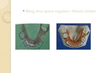 Interceptive Orthodontics in Mixed dentition.ppt