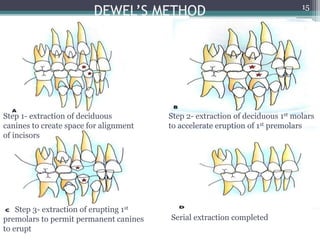 Interceptive Orthodontics by Malik Abdul | PPTX