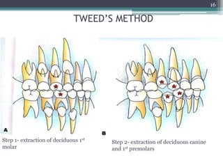 Interceptive Orthodontics by Malik Abdul | PPTX