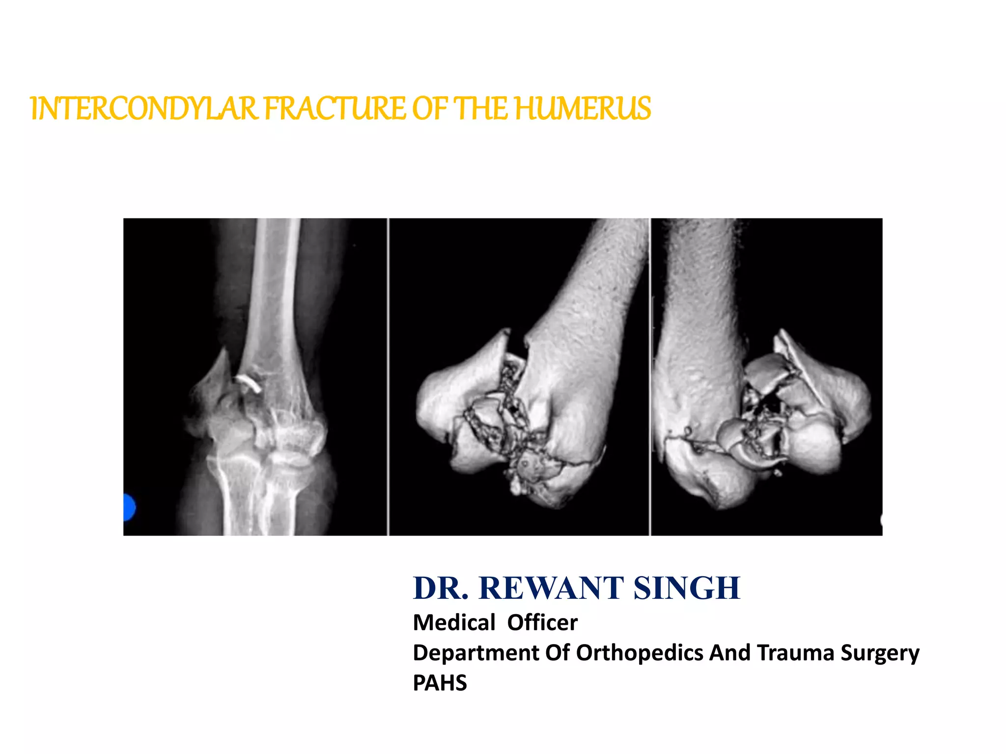 Intercondylar fracture of humerus | PPTX