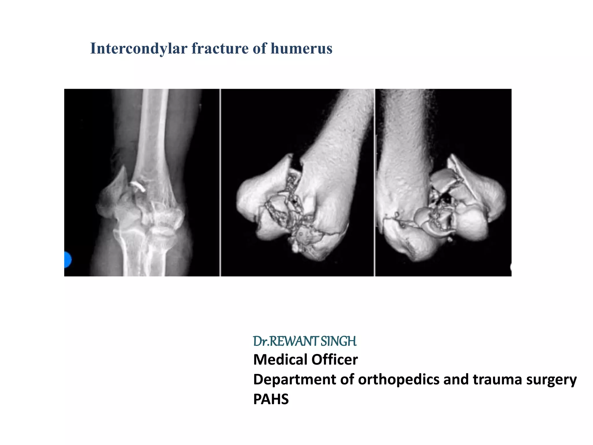 Intercondylar fracture of humerus | PPTX
