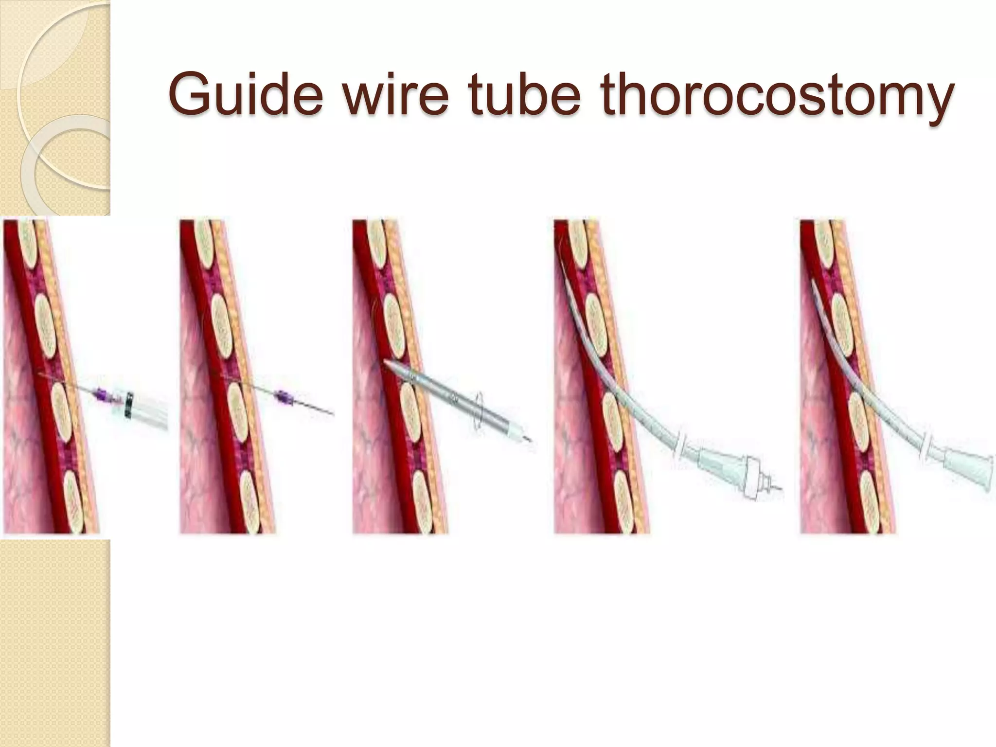 Intercostal drainage | PPTX