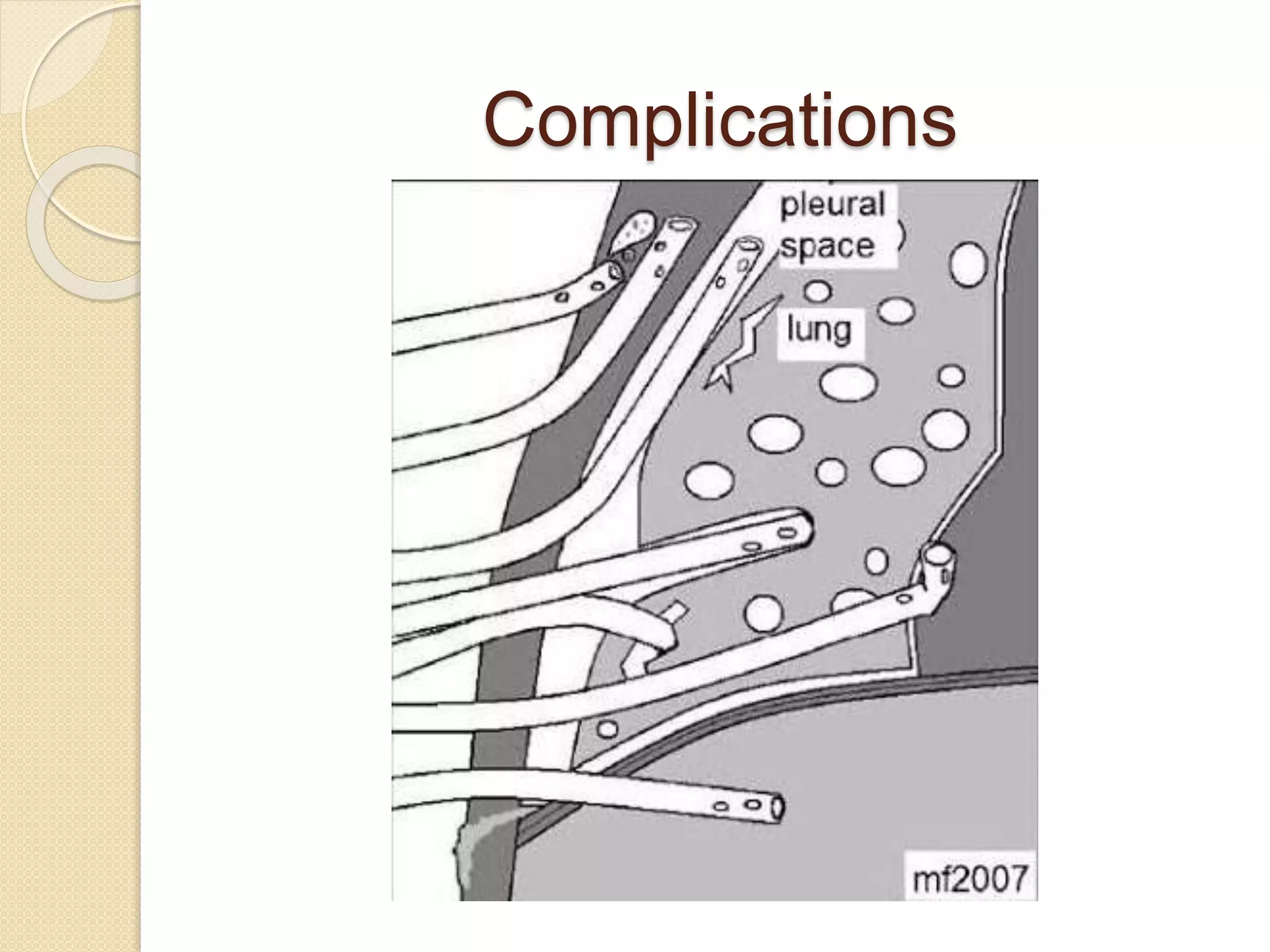 Intercostal drainage | PPTX