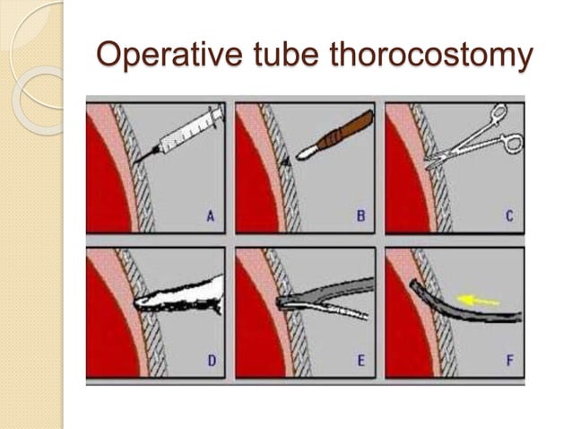 Intercostal drainage | PPTX