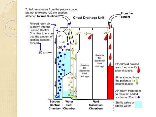 Intercostal drainage | PPTX