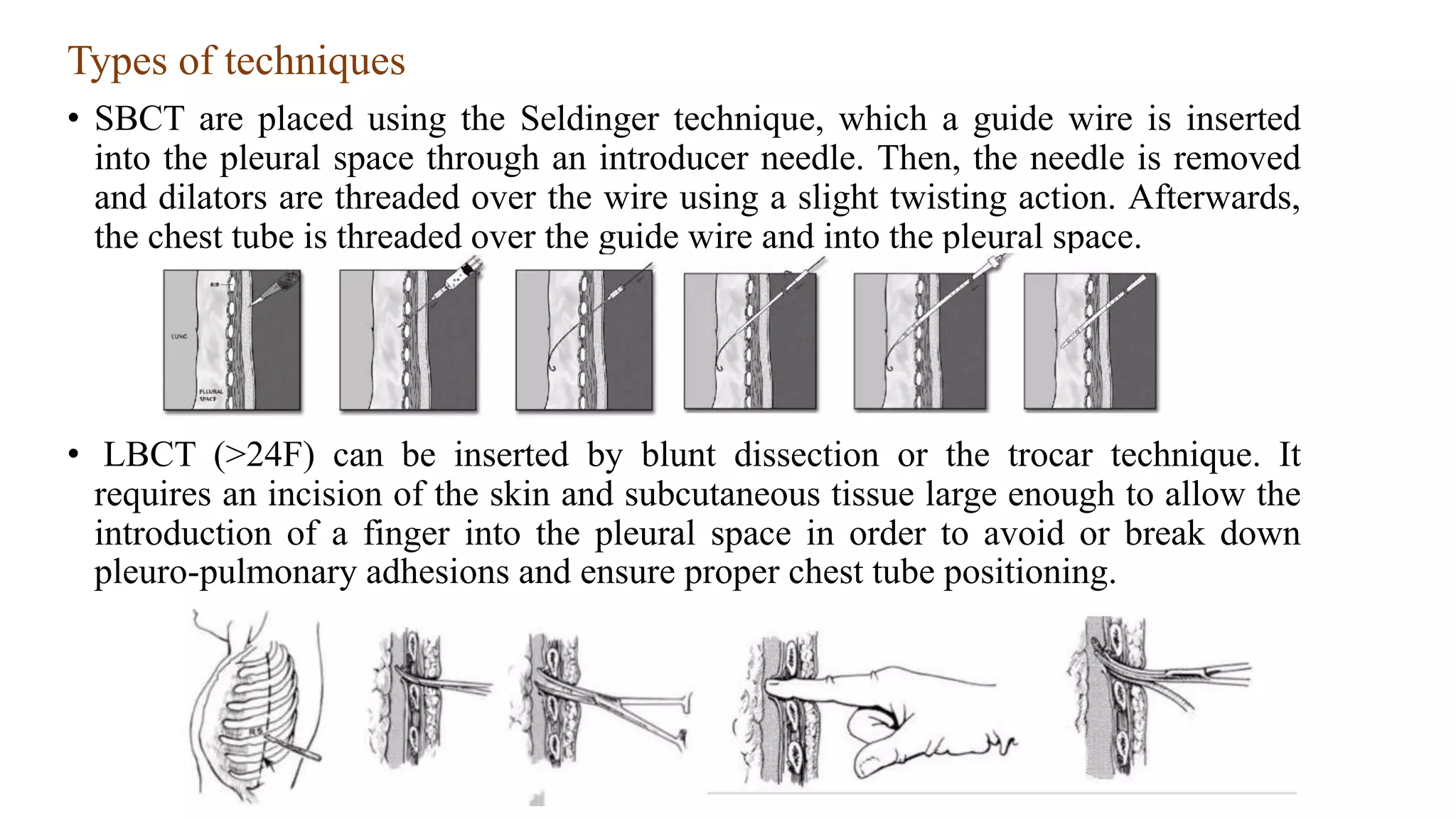 Intercostal drainage tube | PPTX