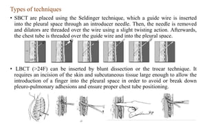 Intercostal drainage tube | PPTX