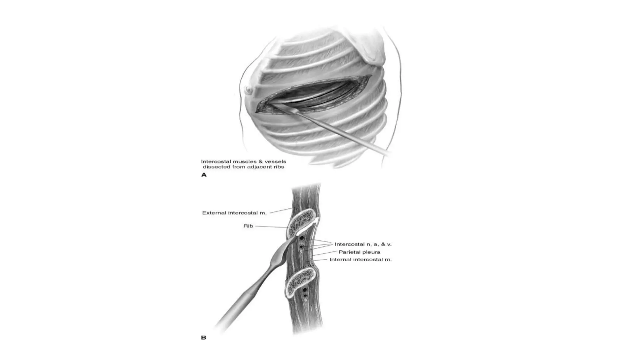 Intercostal muscle flap in reccurent TEF.pptx