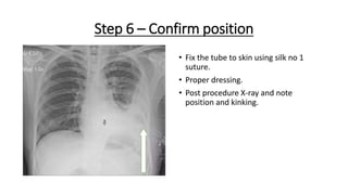 Intercostal Tube Drainage - history ,indications | PPTX