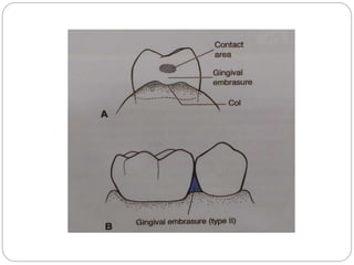 Interdental aids powerpoint presentation | PPTX