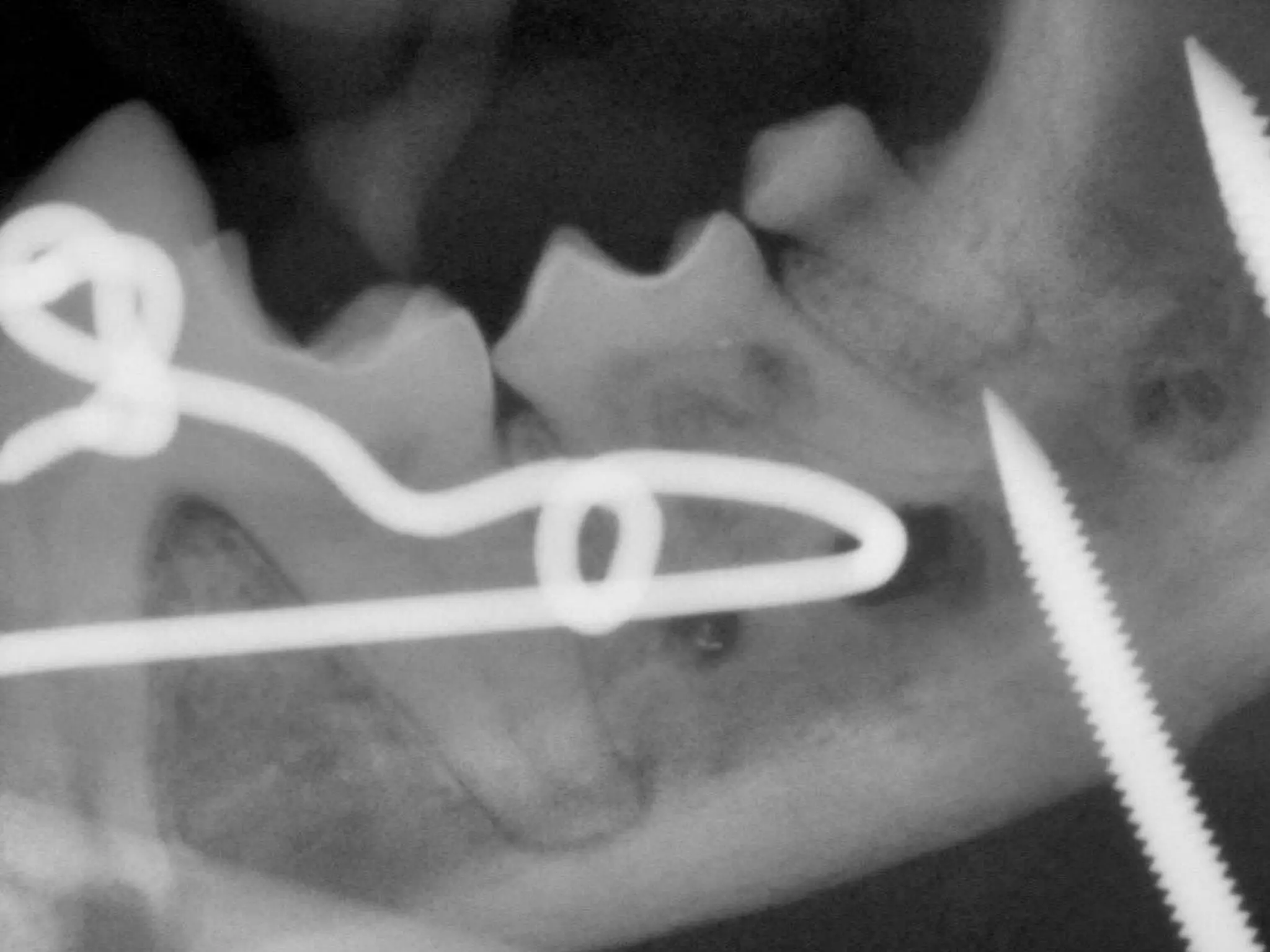 Interdental Wiring for Mandibular Fracture Repair | PPTX