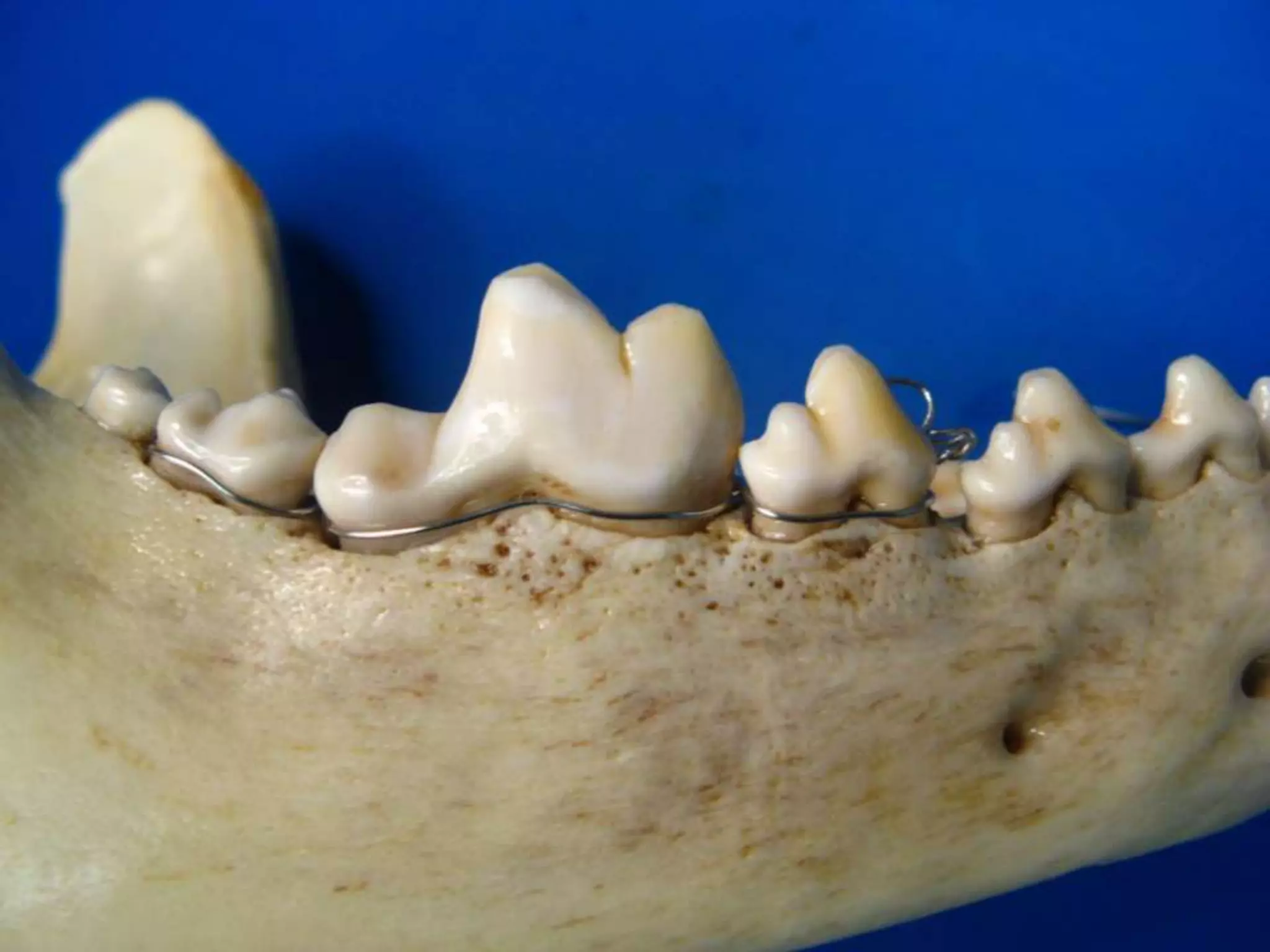 Interdental Wiring for Mandibular Fracture Repair | PPTX