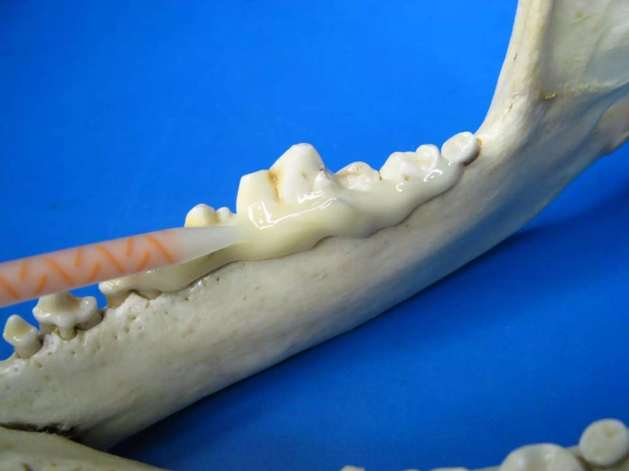Interdental Wiring for Mandibular Fracture Repair | PPTX