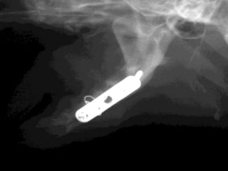 Interdental Wiring for Mandibular Fracture Repair | PPTX