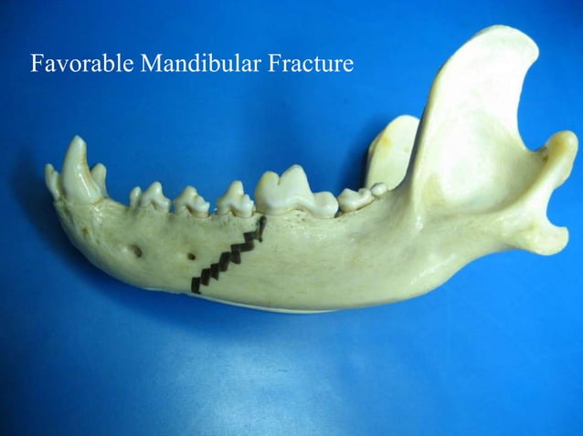 Interdental Wiring for Mandibular Fracture Repair | PPTX | Dental ...