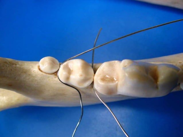 Interdental Wiring for Mandibular Fracture Repair | PPT