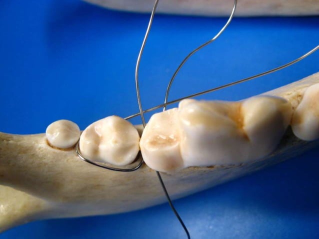 Interdental Wiring for Mandibular Fracture Repair | PPT