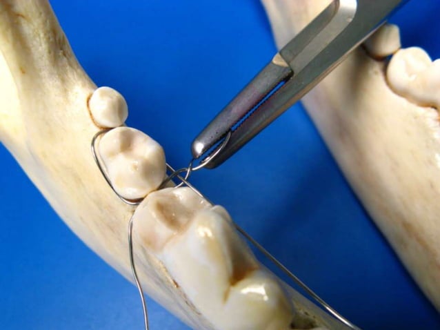 Interdental Wiring for Mandibular Fracture Repair | PPT