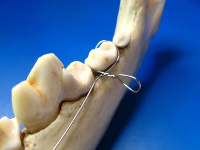Interdental Wiring for Mandibular Fracture Repair | PPTX | Dental ...