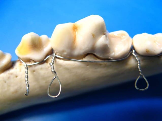 Interdental Wiring for Mandibular Fracture Repair | PPTX | Dental ...