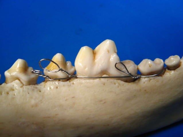 Interdental Wiring for Mandibular Fracture Repair | PPTX | Dental ...