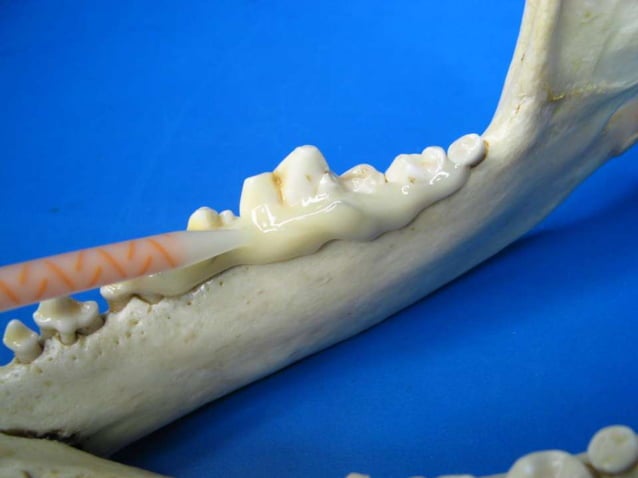 Interdental Wiring for Mandibular Fracture Repair | PPTX | Dental ...