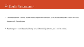 Management of Epulis Fissuratum Using Neutral Zone Technique in ...