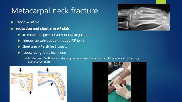 Metacarpal Fracture