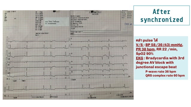 Interesting case ACLS.pdf