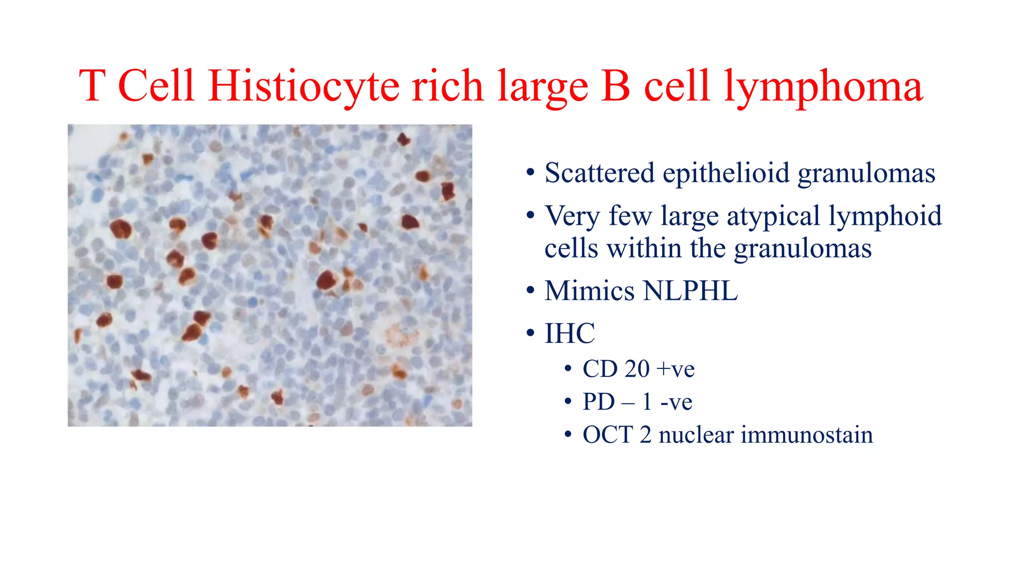 Lymphoma spillover.pptx