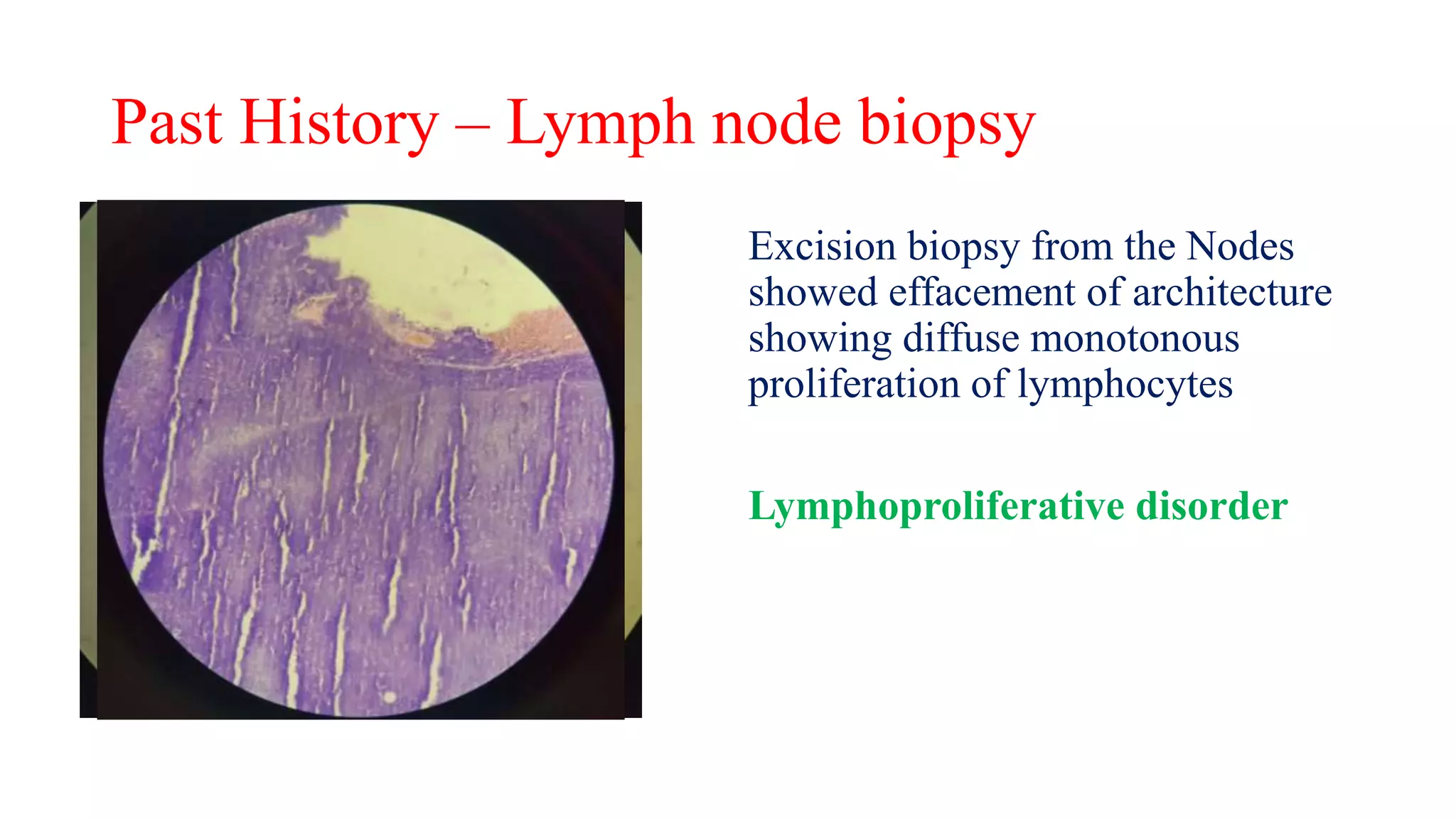 Lymphoma spillover.pptx