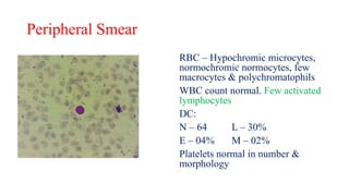 Lymphoma spillover.pptx