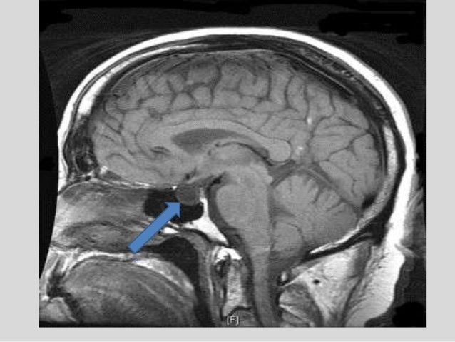 A Case of Sheehan's Syndrome