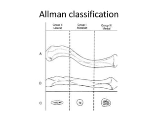 Interesting case orthokorat clavical fracture | PPT