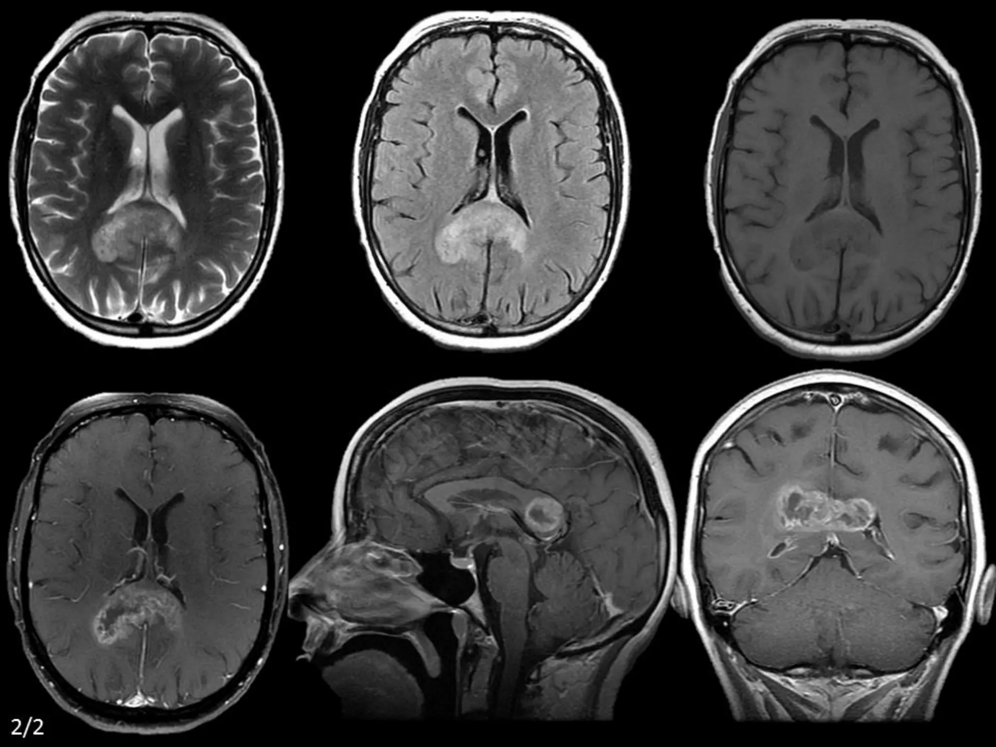 Interesting cases in neuroradiology SOL | PDF