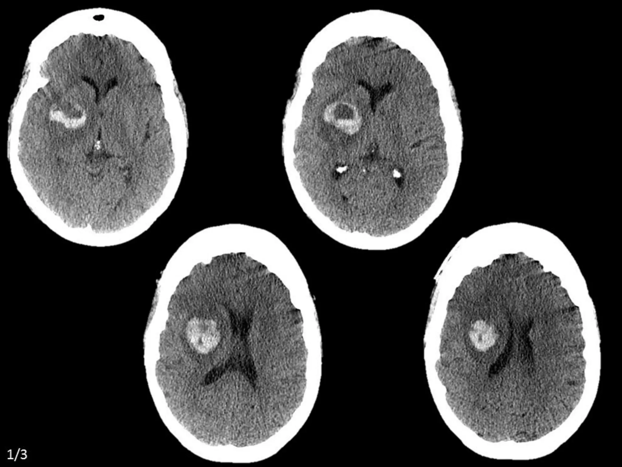 Interesting cases in neuroradiology SOL | PDF
