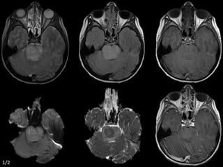 Interesting cases in neuroradiology SOL | PPT