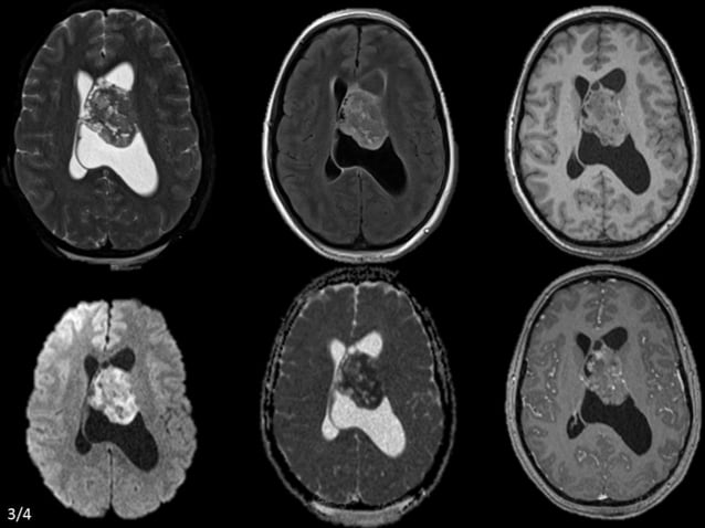 Interesting cases in neuroradiology SOL | PPT