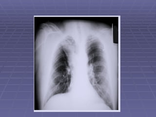 CXR: 'Silhoutte' and other signs | PPT