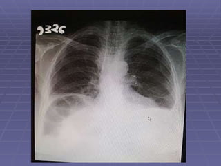 CXR: 'Silhoutte' and other signs | PPT