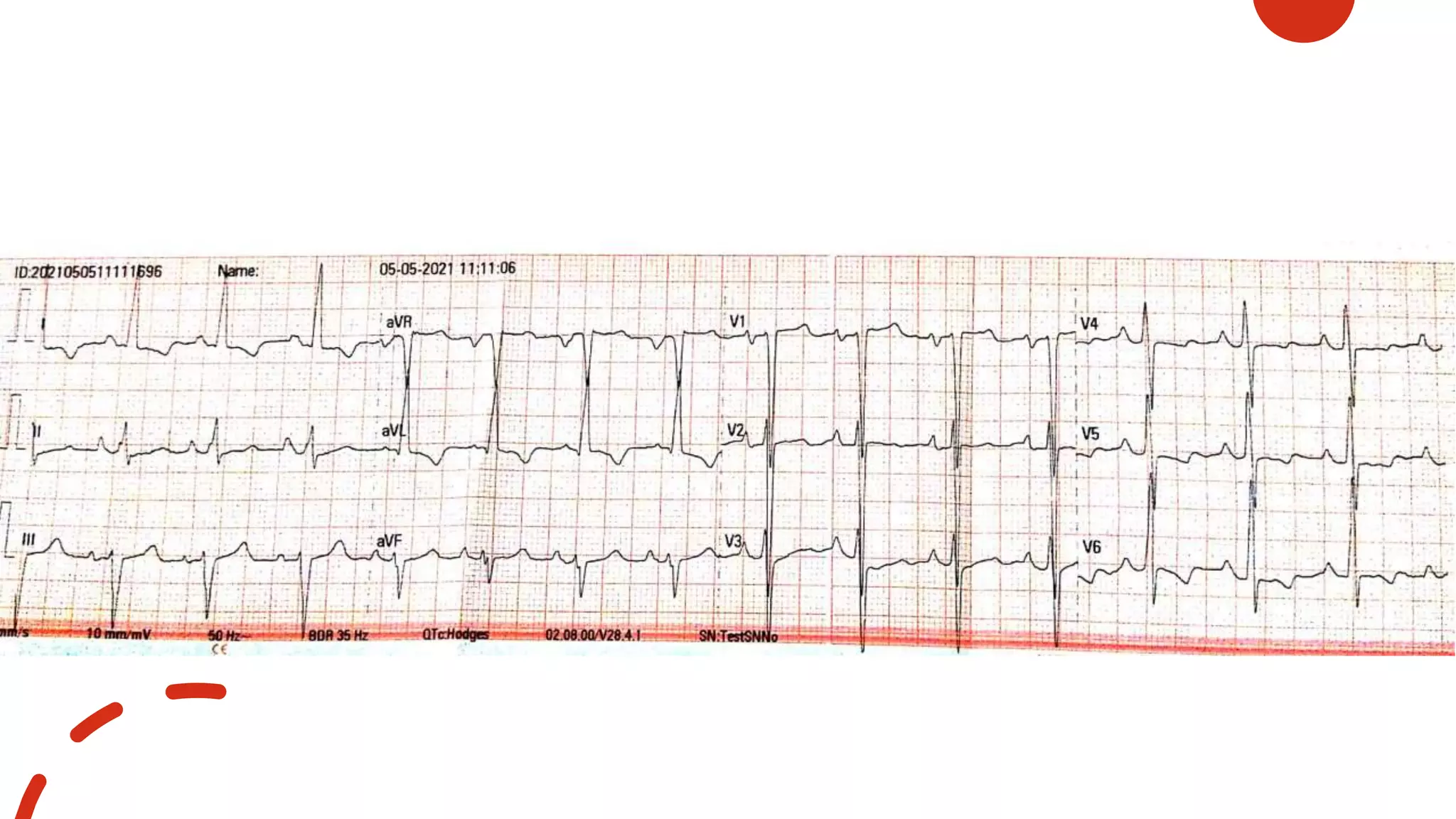 INTERESTING ECGS | PPTX