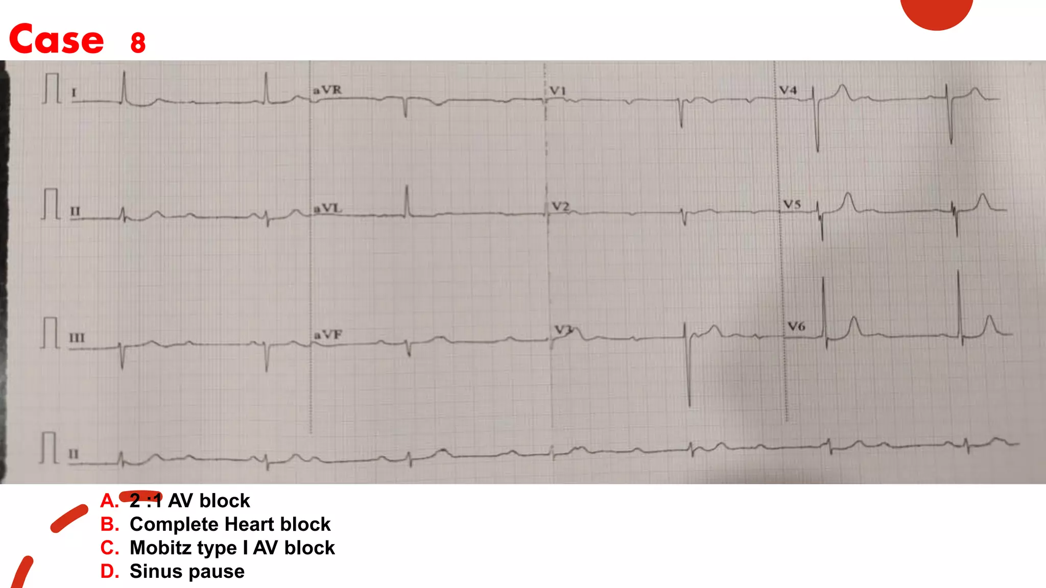 INTERESTING ECGS | PPTX