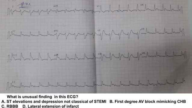 INTERESTING ECGS | PPTX