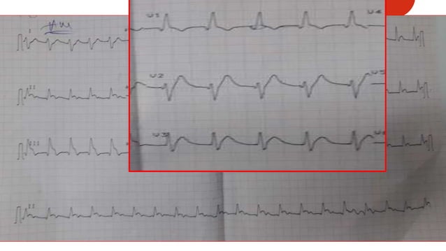 INTERESTING ECGS | PPTX