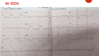 INTERESTING ECGS | PPTX