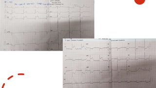 INTERESTING ECGS | PPTX