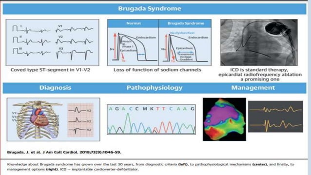 INTERESTING ECGS -- PART II | PPTX | Heart and Cardiovascular Diseases ...